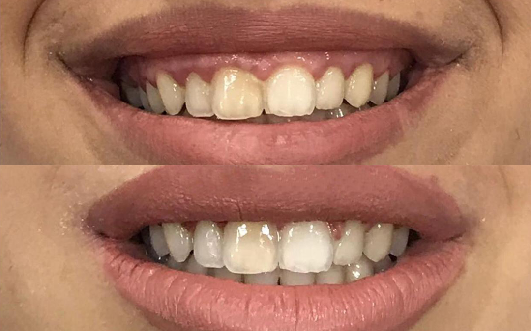 Gum Contouring - Dental Treatment in Turkey
