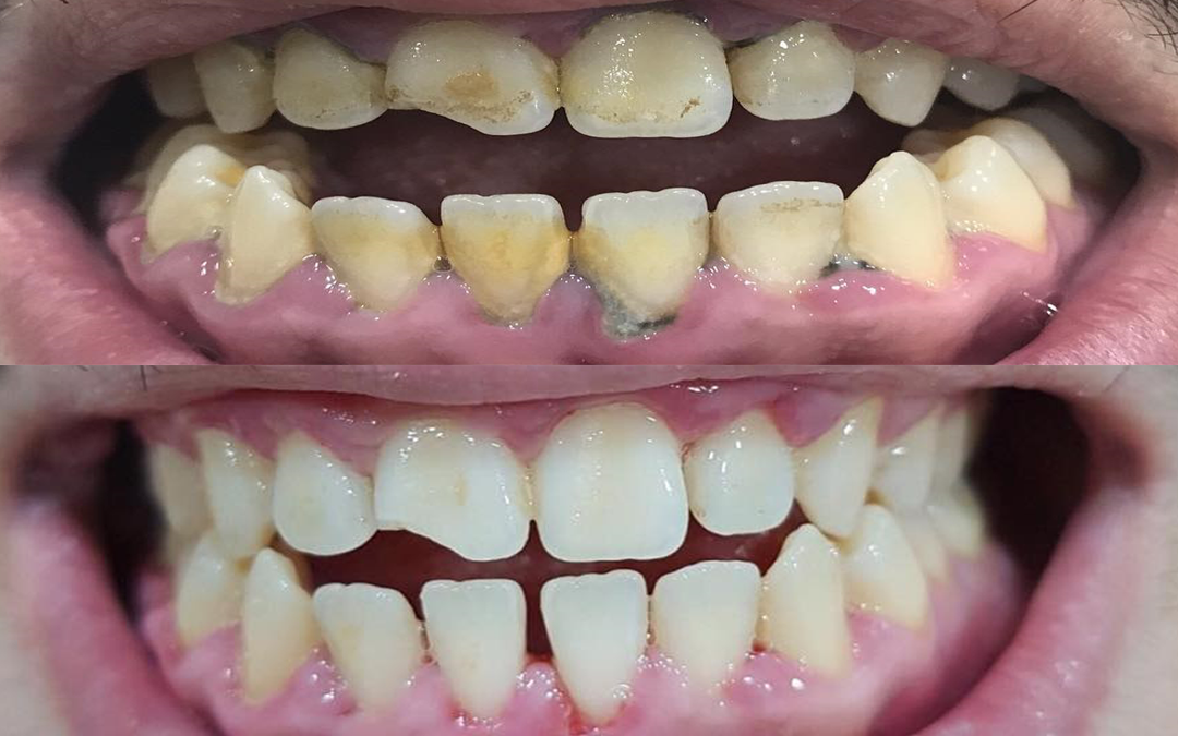 Scale and Polish - Dental Treatment in Turkey